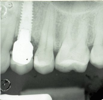 Dentsply Sirona XiVE S (Friadent) Implant dentaire | SpotImplant