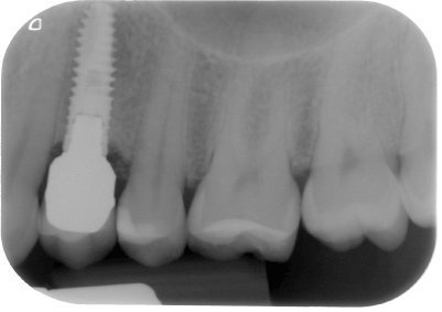 Dentsply Sirona XiVE S (Friadent) Implant dentaire | SpotImplant