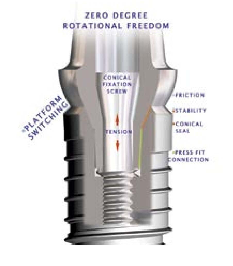 Dyna Dental Helix DC Dental Implant | SpotImplant