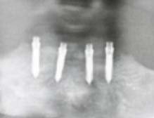 Easy System Implant Mini Implant Dental Implant | SpotImplant