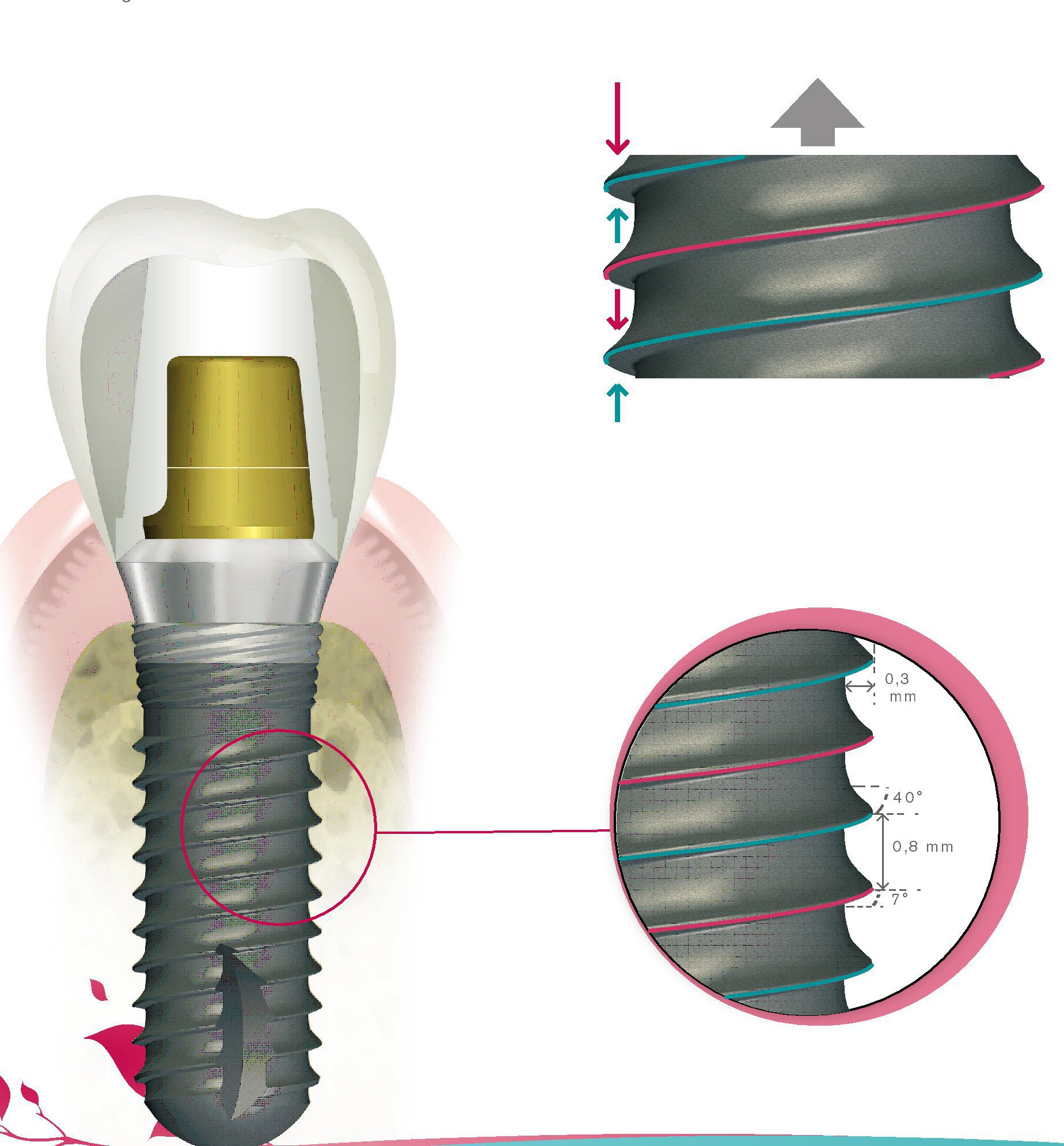 ETK (Euroteknika) Aesthetica+2 Implant dentaire | SpotImplant