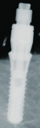 ETK (Euroteknika) Aesthetica+2 Implant dentaire | SpotImplant