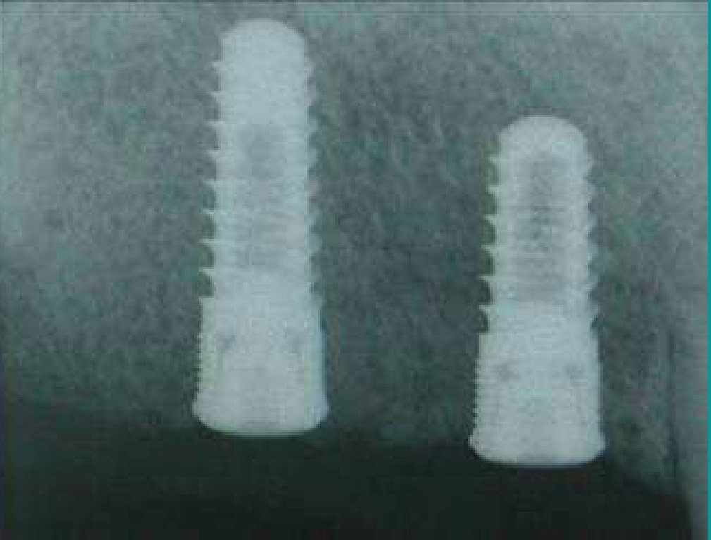 ETK (Euroteknika) Naturall+ Dental Implant | SpotImplant