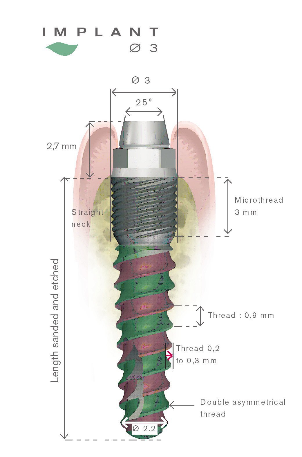 ETK (Euroteknika) Naturall (Natura) External Hex Implant dentaire ...