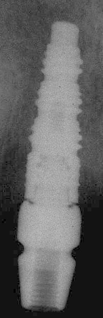 Friadent Frialit-2 Implante dental | SpotImplant