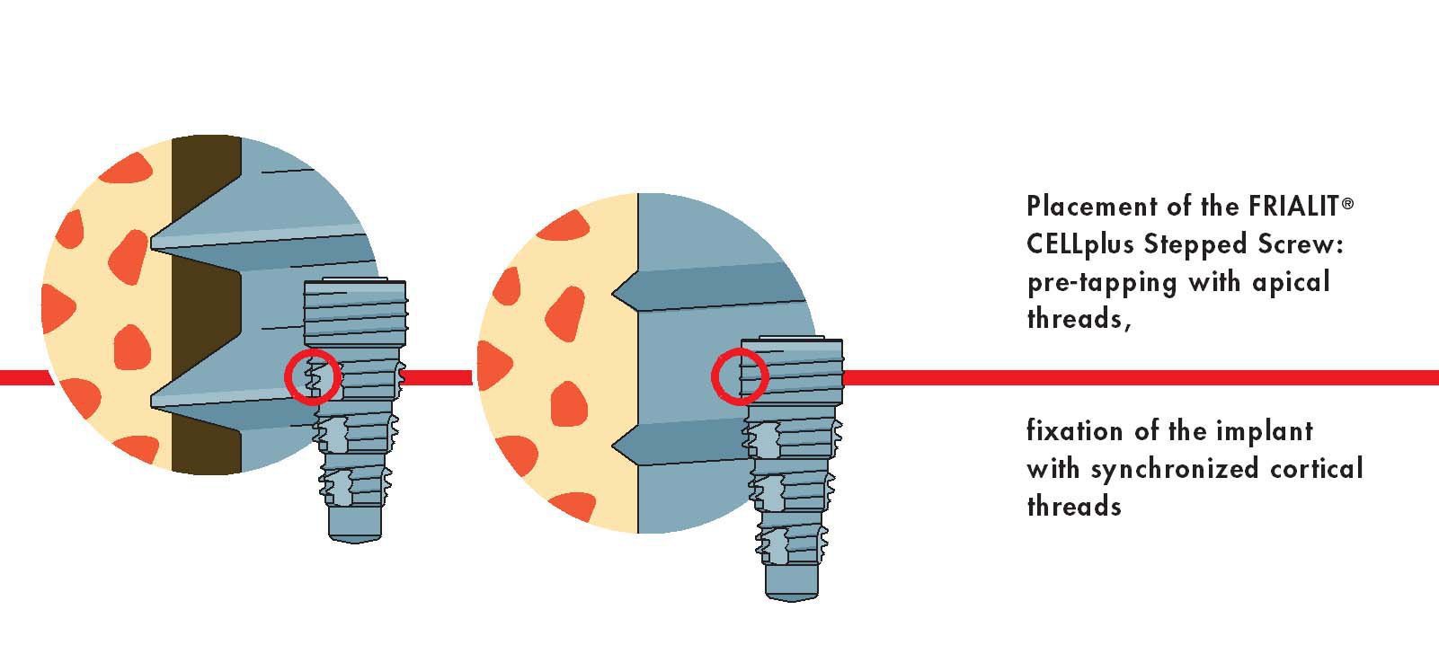 Friadent Frialit-2 Zahnimplantat | SpotImplant