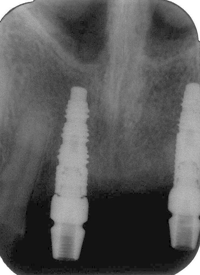 Friadent Frialit-2 Implante dental | SpotImplant