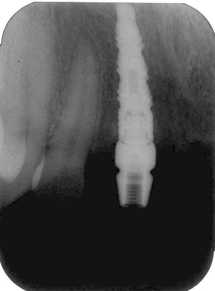 Friadent Frialit-2 Implante dental | SpotImplant