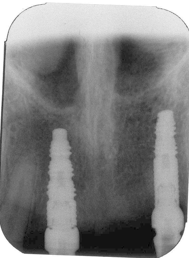 Friadent Frialit-2 Implante dental | SpotImplant