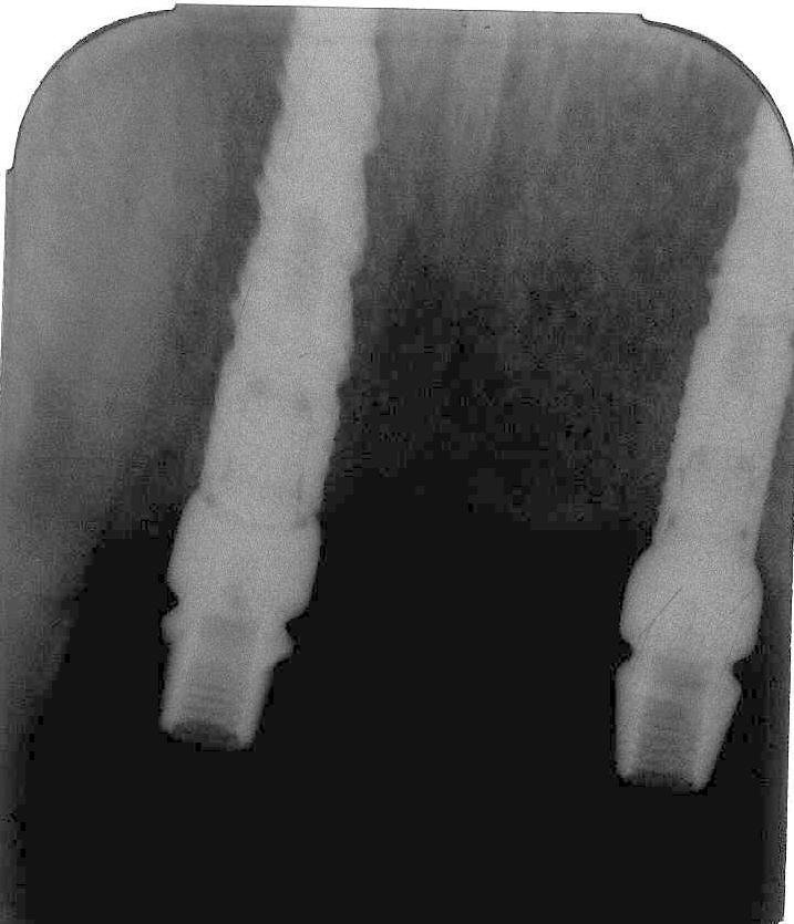 Friadent Frialit-2 Implante dental | SpotImplant