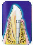 Friadent Frialit-2 Stepped Cylinder Implante dental | SpotImplant