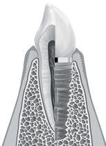 Friadent Frialit-2 Stepped Cylinder Implante dental | SpotImplant