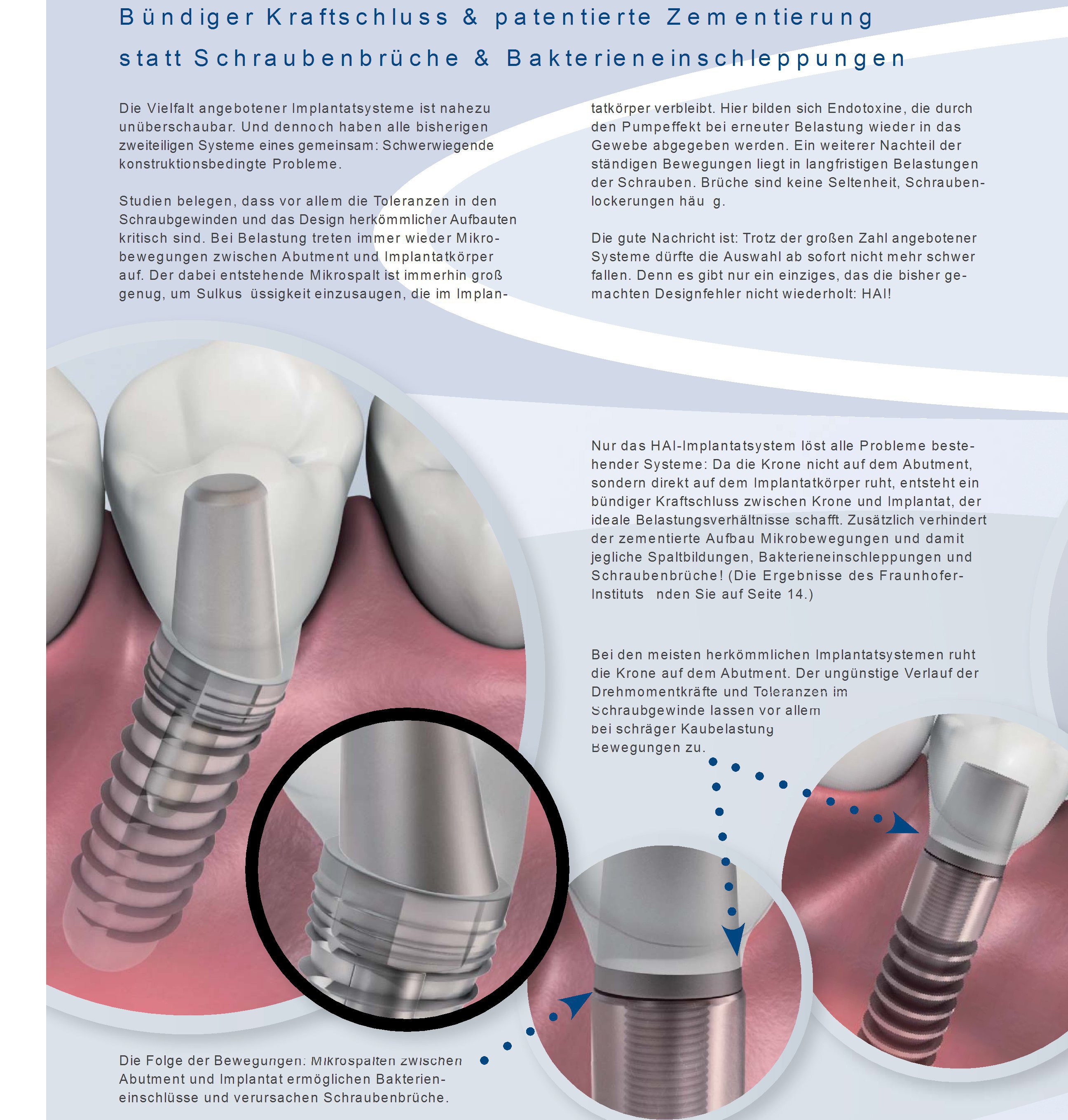 HAI-IMPLANTAT HAI Dental Implant | SpotImplant