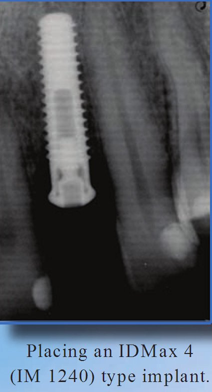 IDI Dental ID Max Dental Implant | SpotImplant