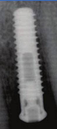IDI Dental ID Max Dental Implant | SpotImplant