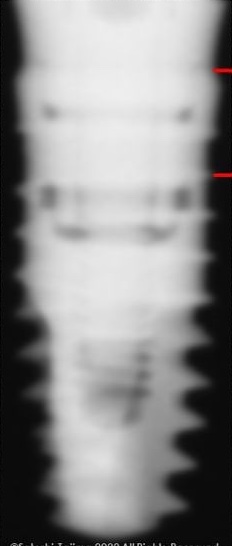Dentsply Sirona XiVE S (Friadent) Dental Implant | SpotImplant