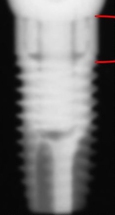 Neoss ProActive Straight Dental Implant | SpotImplant