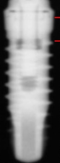 Thommen SPI Element Dental Implant | SpotImplant