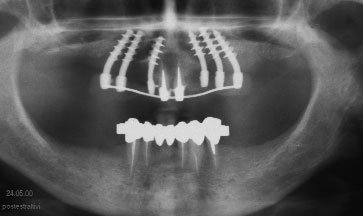 ImplaMed Bicortical Dental Implant | SpotImplant