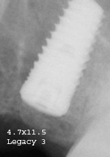 Implant Direct Legacy 2 Implant dentaire | SpotImplant