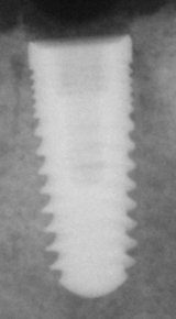 Implant Direct Legacy 2 Implant dentaire | SpotImplant