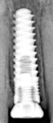 Implant Direct Legacy 2 Implant dentaire | SpotImplant