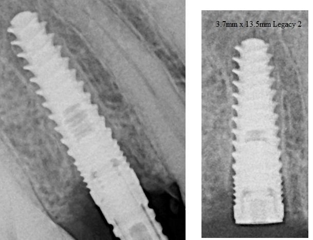 Implant Direct Legacy 2 Impianto dentale | SpotImplant