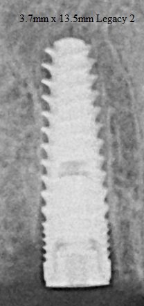 Implant Direct Legacy 2 Implant dentaire | SpotImplant