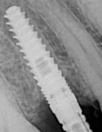 Implant Direct Legacy 2 Implant dentaire | SpotImplant