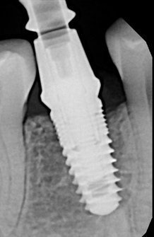 Implant Direct ReActive Implant dentaire | SpotImplant