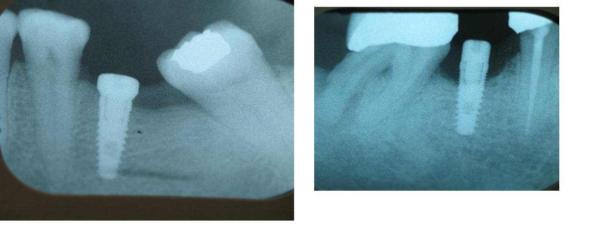 Implant Direct ReActive Implant dentaire | SpotImplant