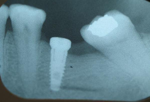 Implant Direct ReActive Implante dental | SpotImplant
