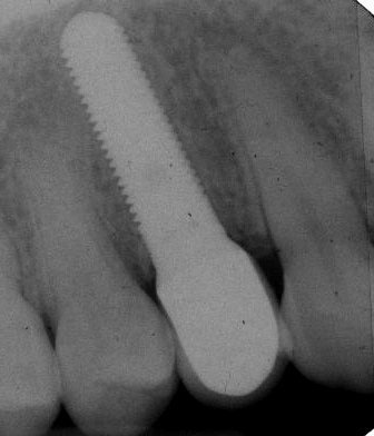 Implant Direct ScrewPlant Dental Implant | SpotImplant