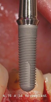Implant Direct ScrewPlant Dental Implant | SpotImplant