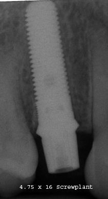 Implant Direct ScrewPlant Dental Implant | SpotImplant
