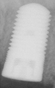 Implant Direct ScrewPlant Dental Implant | SpotImplant