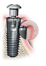 IMTEC Endure CL Implante dental | SpotImplant