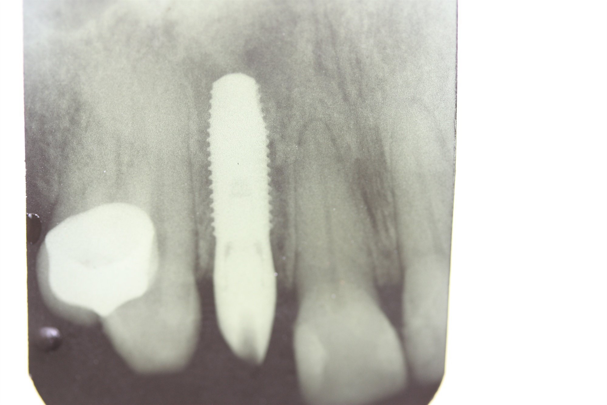 IMTEC Endure CL Implante dental | SpotImplant