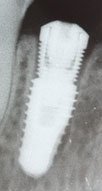 IMTEC Endure CL Implante dental | SpotImplant