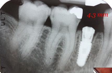 IMTEC Endure CL Implante dental | SpotImplant