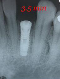 IMTEC Endure CL Implante dental | SpotImplant