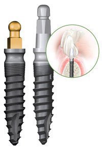 IMTEC MDI Hybrid (Tapered Abutment) Implante dental | SpotImplant