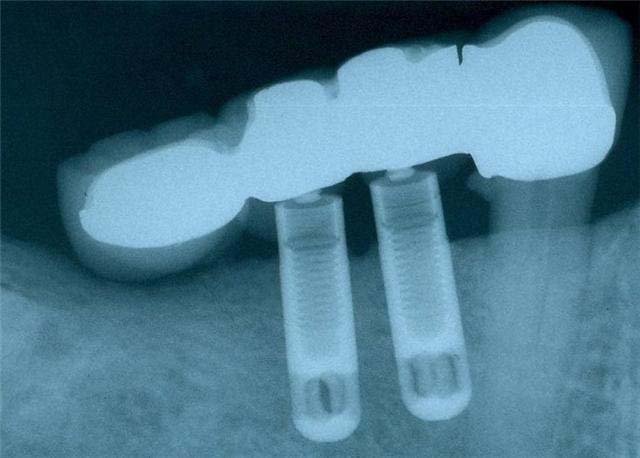 IMZ IMZ Hex Head Implant dentaire | SpotImplant