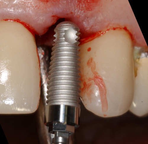 Intra-Lock System International External Hex Conic Dental Implant ...