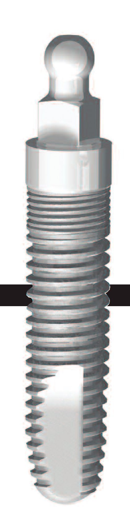 Intra-Lock System International Milo Implant dentaire | SpotImplant