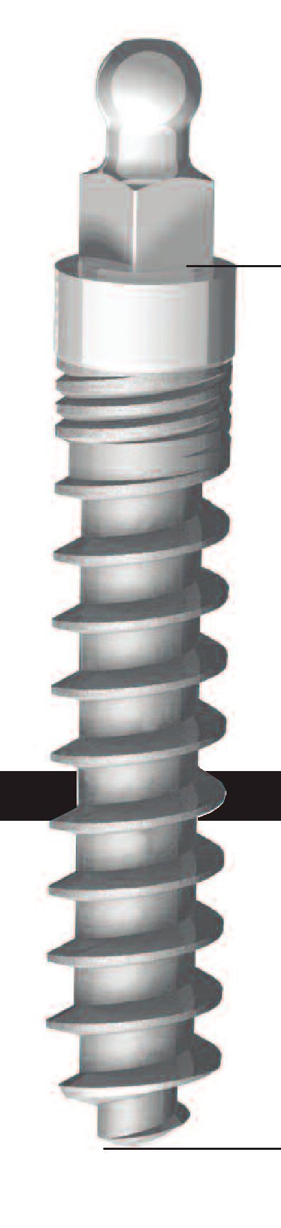 Intra-Lock System International Milo Implant dentaire | SpotImplant