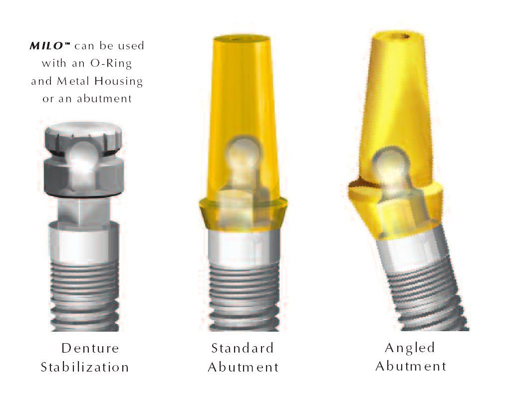 Intra-Lock System International Milo Implant dentaire | SpotImplant
