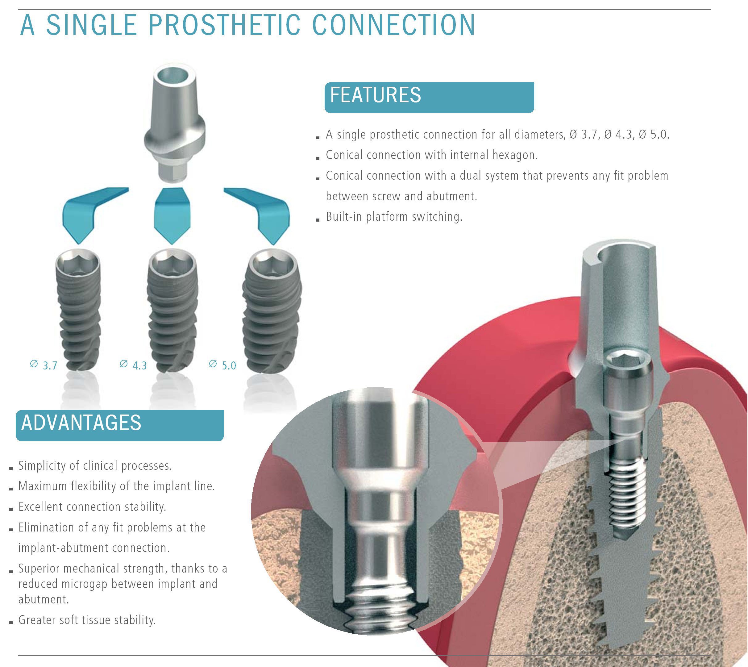 JDentalCare JDEvolution Implante dental | SpotImplant