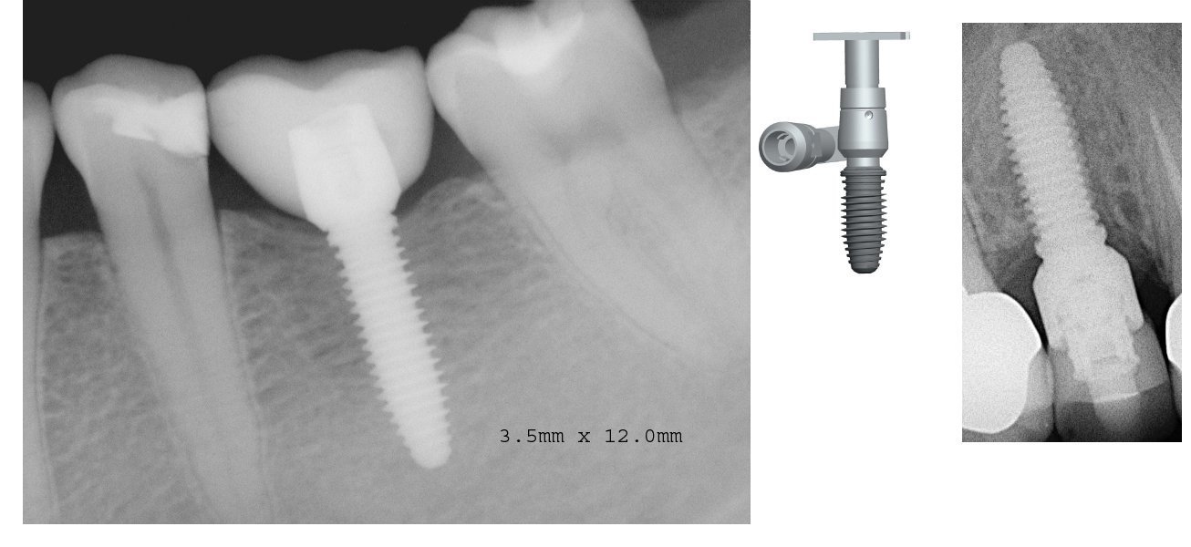 KAT Implants KAT Dental Implant | SpotImplant