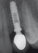 Leone Exacone Dental Implant | SpotImplant